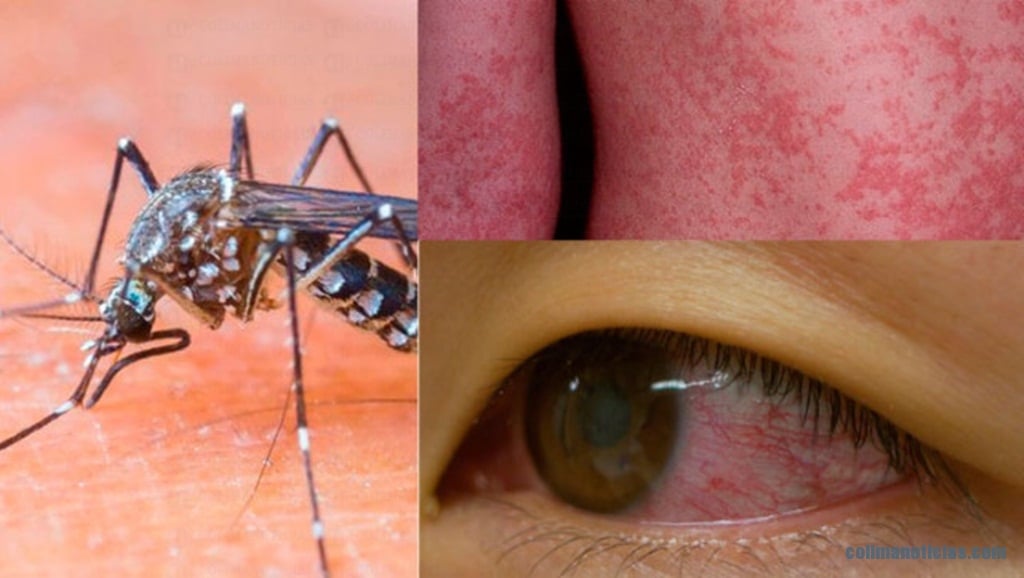 Lo que necesitas saber acerca del Zika | Colima Noticias